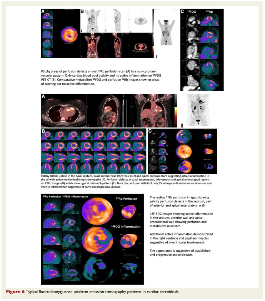Diagnostic et prise en charge de la sarcoïdose cardiaque – Paris echo